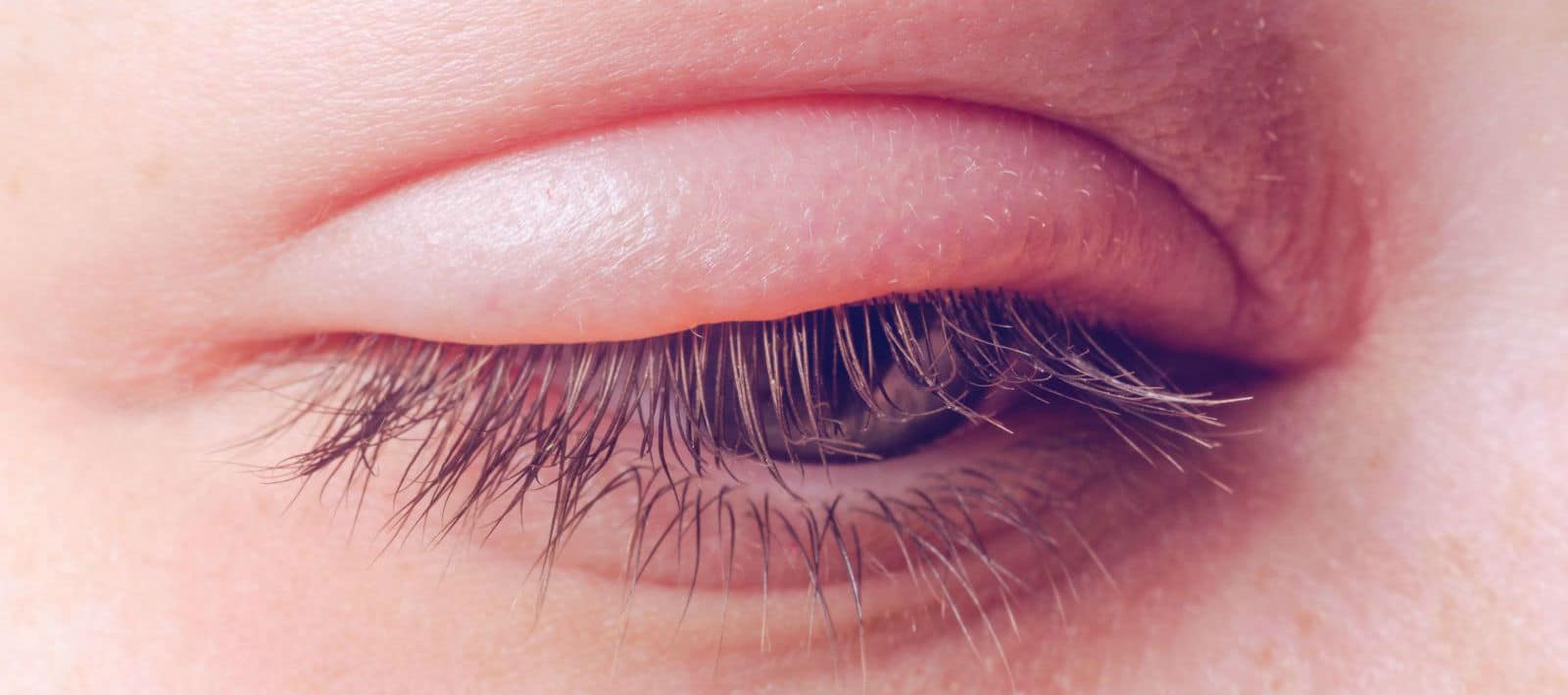 Blefaritis: ¿Qué es y por qué se produce? - OFTALMOPLUS